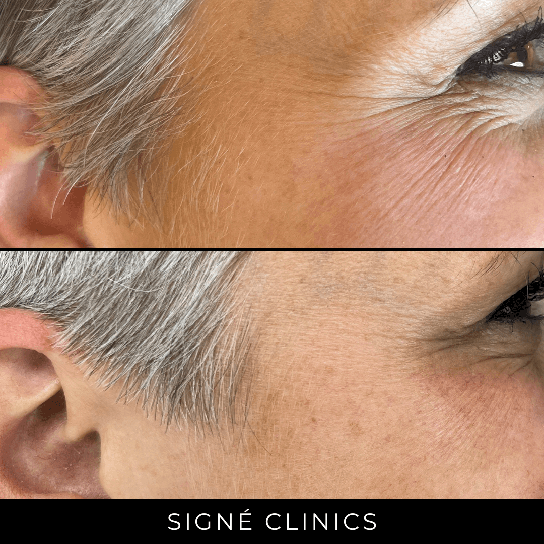 Botox Behandeling | Signé Clinics | Rotterdam & Tilburg